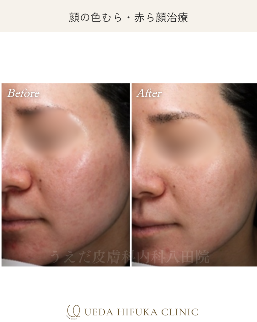 フォト美肌治療（ノーリス）【Case No.101】 | うえだ皮膚科内科 八田院 | 名古屋市中川区