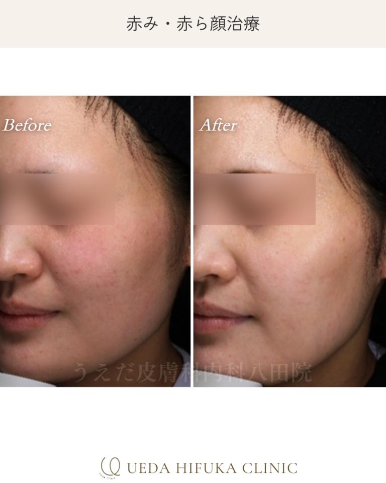 case_102_nordlys | うえだ皮膚科内科 八田院