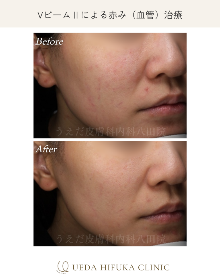 case_106_vbeam | うえだ皮膚科内科 八田院